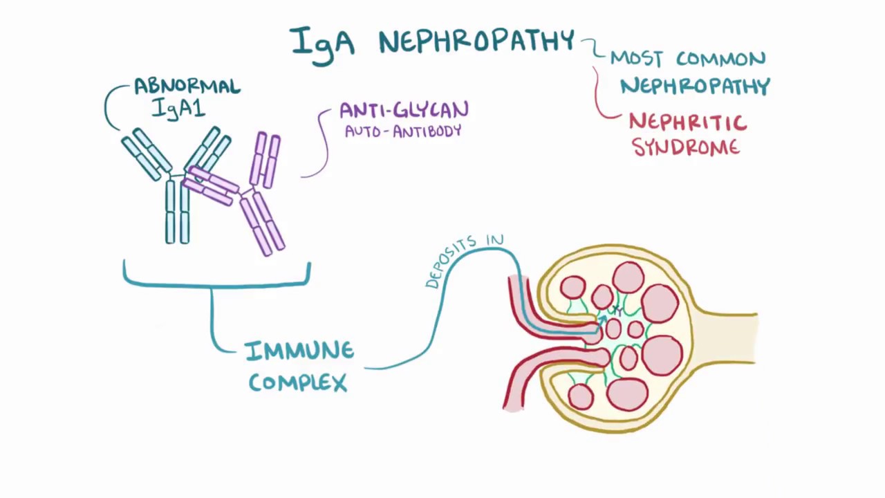 Iga Nephropathy Creates Bloated Face